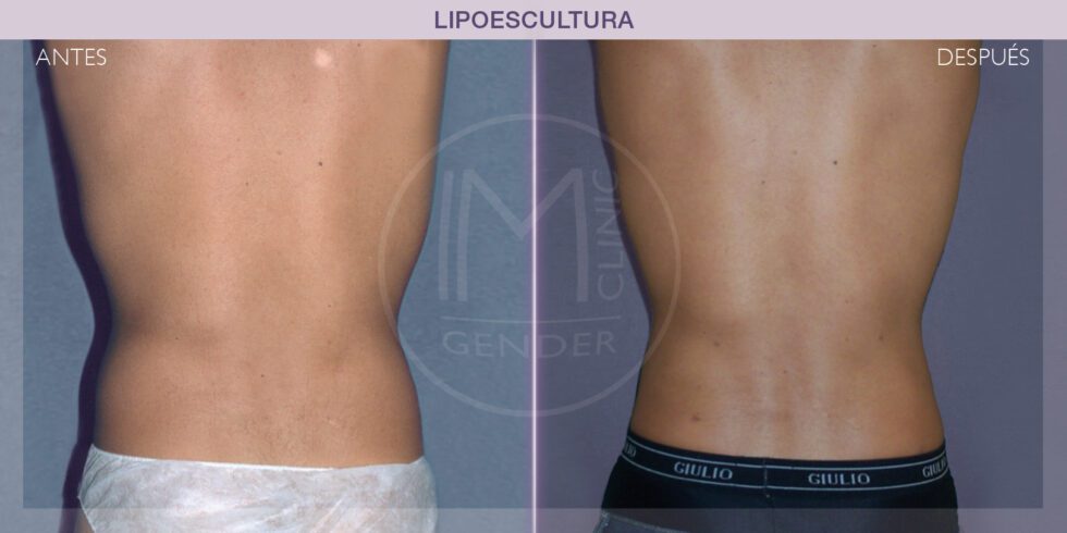 MTF Body Contouring | Transgender Liposuction | IM GENDER